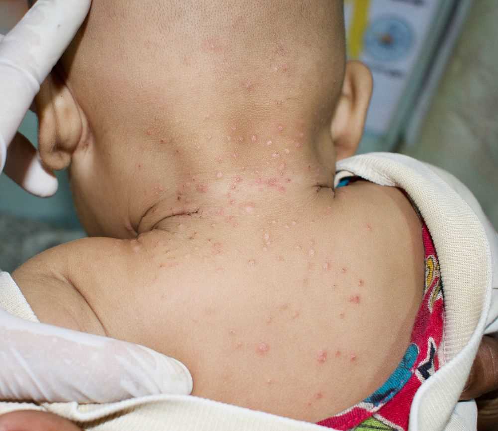 Molusky u dětí - příčiny, příznaky a léčba | Návod a rady - Duben 2024 ...